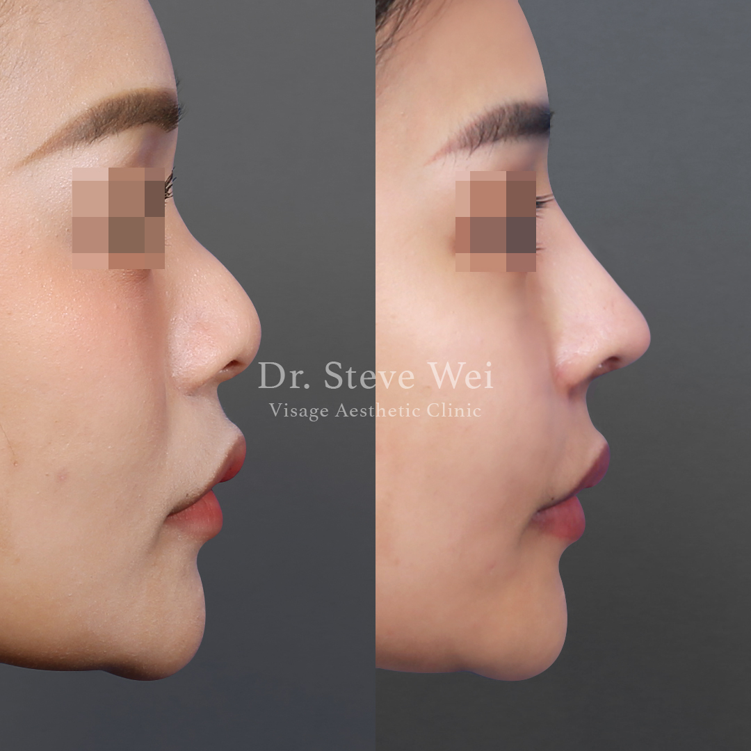 ｜隆鼻重修｜揮別感染攣縮鼻 - 慕顏時尚美學診所
