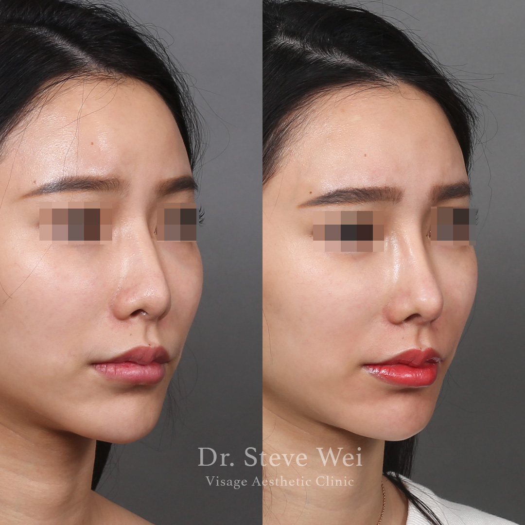 ｜結構式隆鼻｜清除埋線 塑型優雅弧線 - 慕顏時尚美學診所